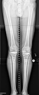 Patient interview at day 11 following HTO and precision bone wedge ...